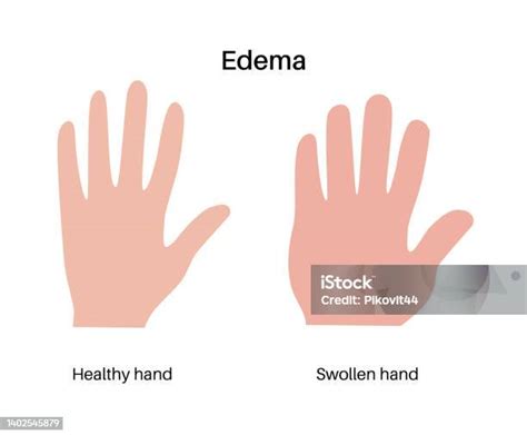 팔의 부종 부은에 대한 스톡 벡터 아트 및 기타 이미지 부은 벡터 손 Istock