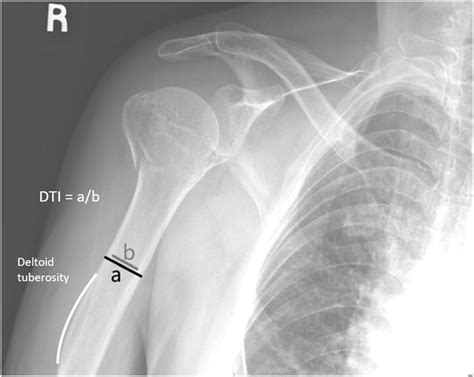 Deltoid Tuberosity Of Humerus Deltopectoral Approach To The Proximal