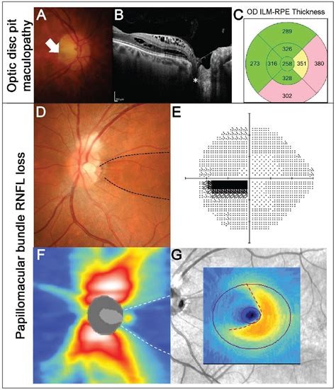Six Questions About The Role Of Oct In Neuro Evaluations