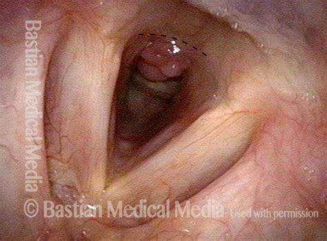 Granulation Tissue Over Healing In The Throat