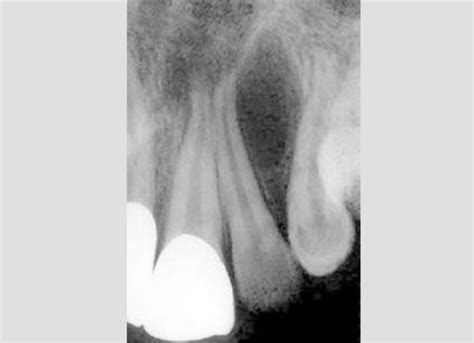Kennedy Classification And Applegates Rule Focus Dentistry