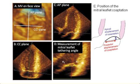 Cleft Mitral Leaflet Echo Mitral Valve Echo Chart Buif