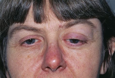 Meningioma Eye Bulge Stock Image M2100218 Science Photo Library