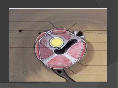 Traumatic Optic Neuropathy Pptx