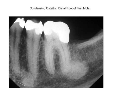 Condensing Osteitis Vital At Lilian Dixson Blog