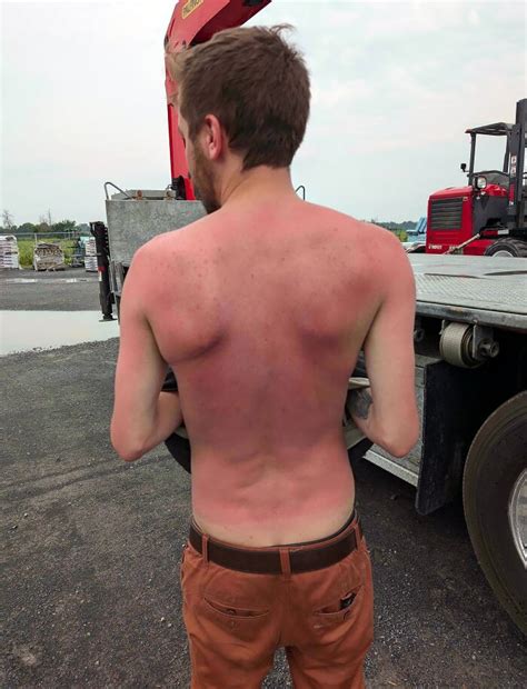 50 Times People Posted Their Embarrassing Sunbathing Fails So You Can