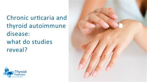 Thyroid Federation International On Linkedin Urticaria Itchyrash Autoimmuity Autoimmune