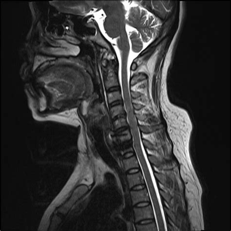 Pyogenic Discitis With An Epidural Abscess After Cervical Analgesic