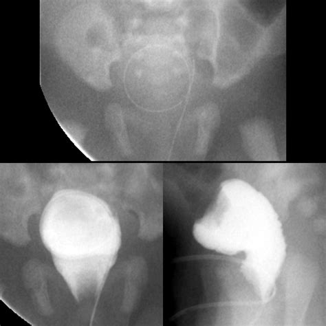 Pediatric Vesicoureteral Reflux Pediatric Radiology Reference Article
