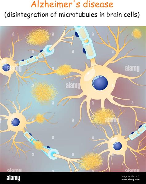 Alzheimers Disease Dementia Vector Background With Neurons And