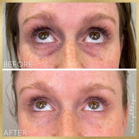 Tear Trough Gallery Dontage