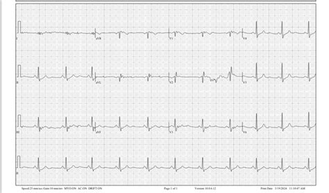 Abnormal Ekg Dont Understand My Results R Askdocs
