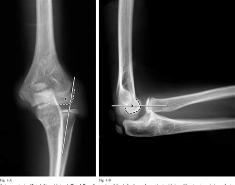 Radial Head Subluxation Msk Medbullets Step 1