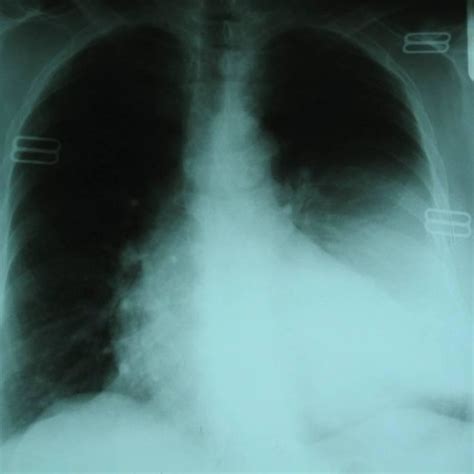 4 An Intra Operative View Through A Left Posterolateral Thoracotomy
