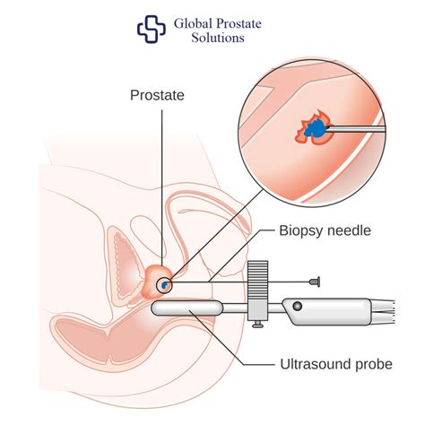 What Is A Prostate Biopsy Latp Biopsy Benefits And Risks