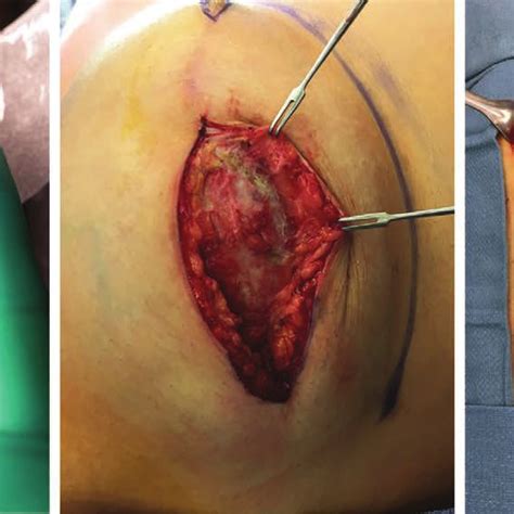 Use Of Acellular Dermal Matrices In Breast Reconstruction Acellular