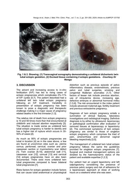 Unilateral Dichorionic Twin Tubal Ectopic Pregnancy Following Fresh In Vitro Fertilization And