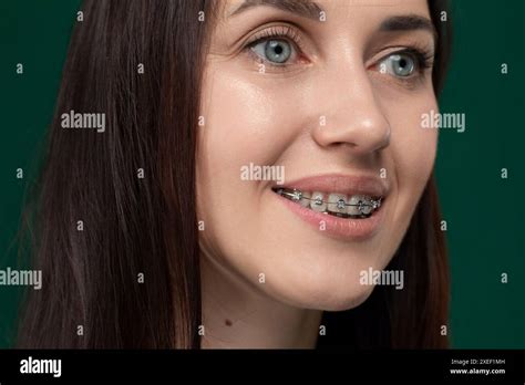 Woman With Braces Smiling Stock Photo Alamy