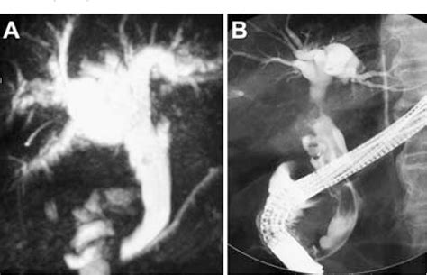 Figure 1 From A Case Of Mucin Producing Cholangiocarcinoma Arising From