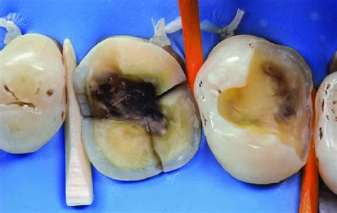 Situation After Amalgam Restoration Removal And Preparation For The