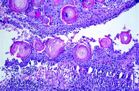 Odontogenic Cysts Pocket Dentistry