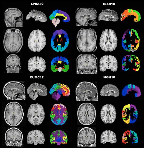 Figure 1 From Evaluation Of 14 Nonlinear Deformation Algorithms Applied To Human Brain Mri