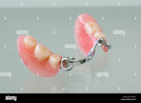 Claspless Partial Dentures