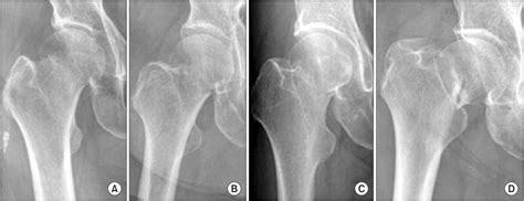 Garden Classification Of Femoral Neck Fractures Hip Fracture Lucoxcl