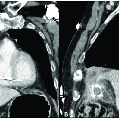 Ab Contrast Enhanced Ct And Coronal A And Sagittal Planes B Show