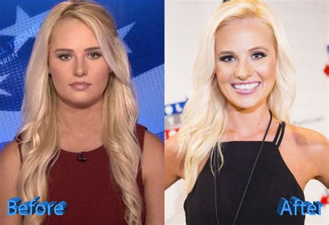 Tomi Lahren Plastic Surgery Making Headlines For Her Face