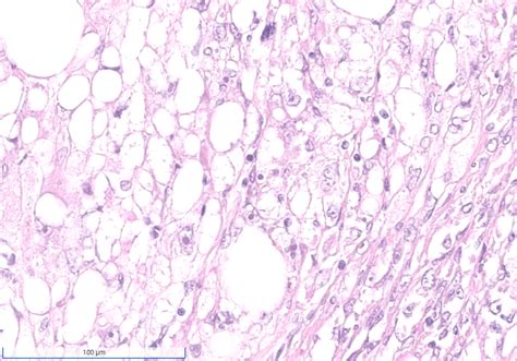 Week 770 Case 1 Johns Hopkins Surgical Pathology Unknown Conference