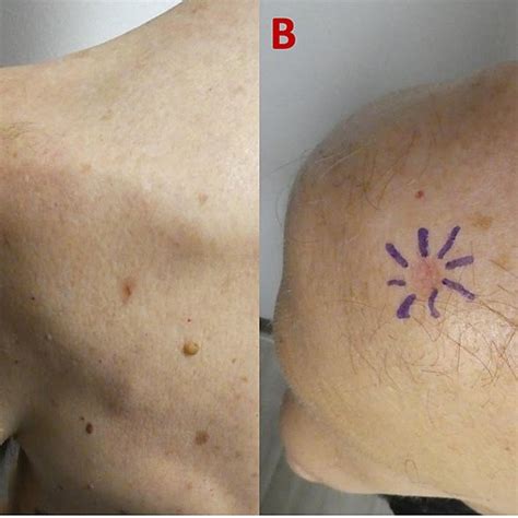 Histologic Features Of Atrophic Dermatofibroma On The Left Shoulder Of