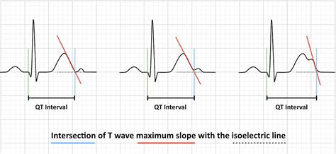 Qtc Normal Range