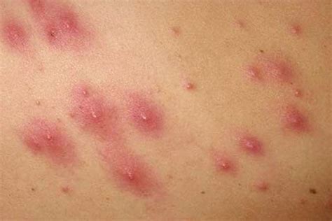 How To Cure Small Itchy Bumps On Skin