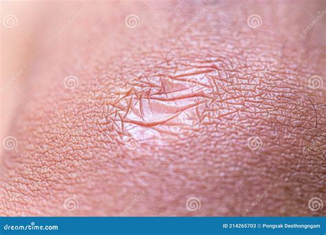 Big Keloid Scar Stock Photography CartoonDealer 182485520
