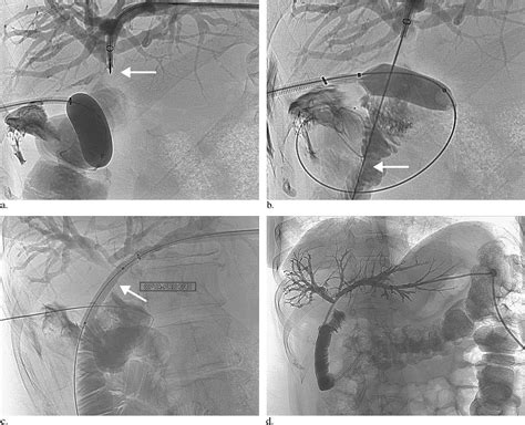 Fluoroscopy Guided Hepaticoneojejunostomy In Recurrent Anastomotic Stricture After Repeated