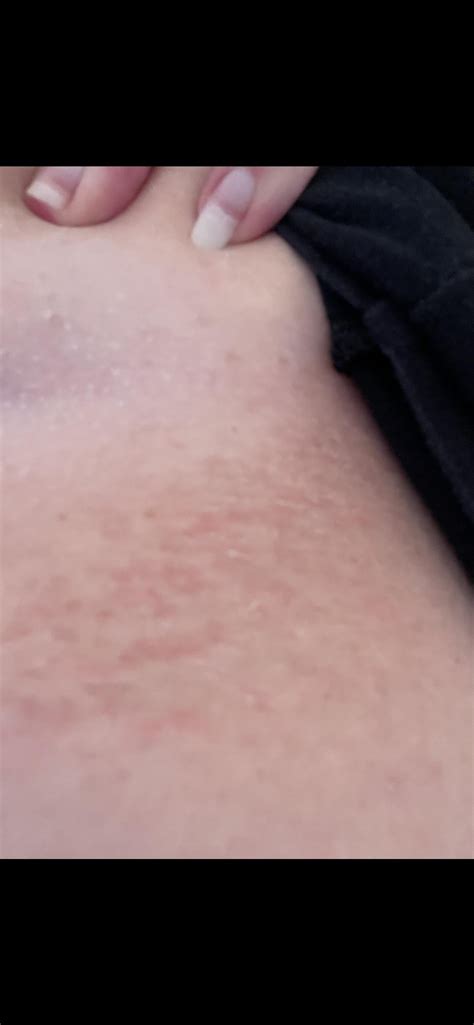 Is This Yeast Or Fungus Or Dermititis R Candida