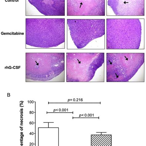 Necrosis Induced By The Gemcitabine And Rhg Csf Treatments A Hande