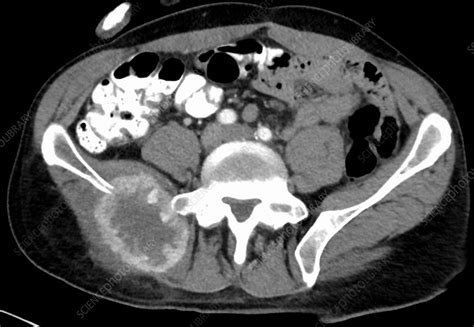 Metastatic Renal Carcinoma Pelvis Ct Scan Stock Image C0393868