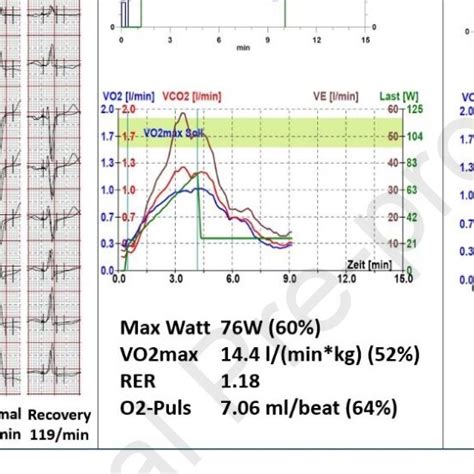 Exercise Test Before And After Hbp Implantation A Ecgs During Download Scientific Diagram