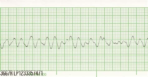 ACLS Review Pulseless VF VT Part 5