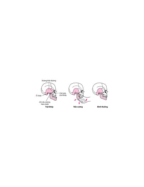 Sai Khớp Hàm Dưới Rối Loạn Nha Khoa Cẩm Nang Msd Phiên Bản Dành