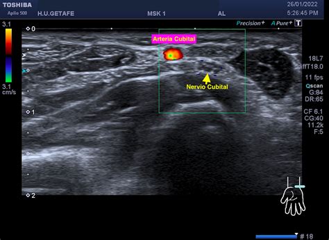 342 Canal De Guyon Y Caso Clínico Ecografía Fácil