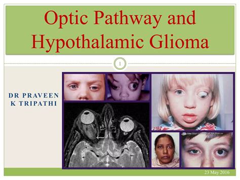 Optic Pathway Glioma Pptx