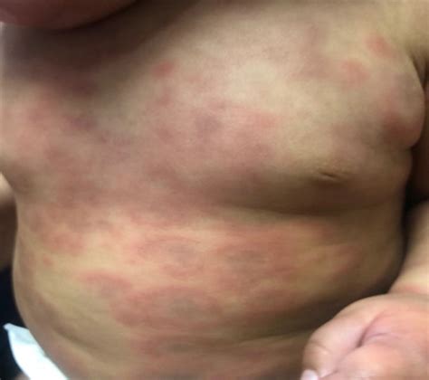 Urticaria Multiforme The Journal Of Pediatrics