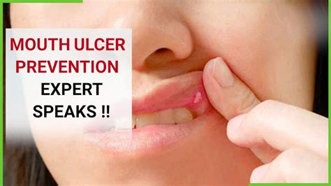 Mouth Ulcer Prevention How To Cure Ulcers By Following These Basic