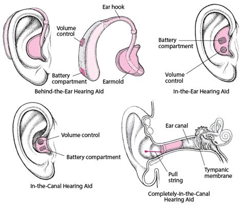 Management Of Hearing Loss Ear Nose And Throat Disorders Msd Manual Consumer Version