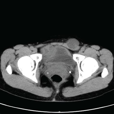 A Ct Displaying A 30 Mm Low Density Mass In The Left Inguinal Region