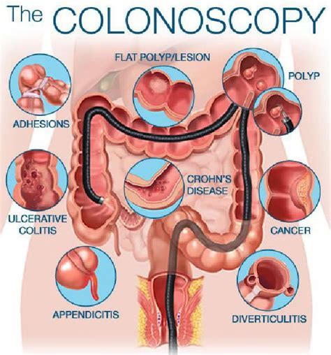 Can A Colonoscopy Detect Ibs Or Diverticulitis