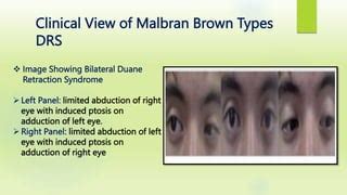 Duanes Retraction Syndrome Pptx